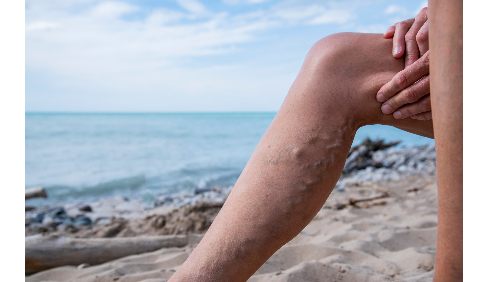 Bye Bye Varicose Veins - 21st Century Products Sdn Bhd